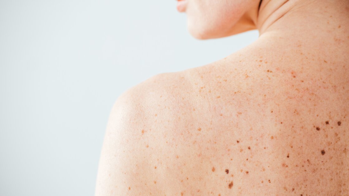 Hautkrebs | DasKrebsportal.de