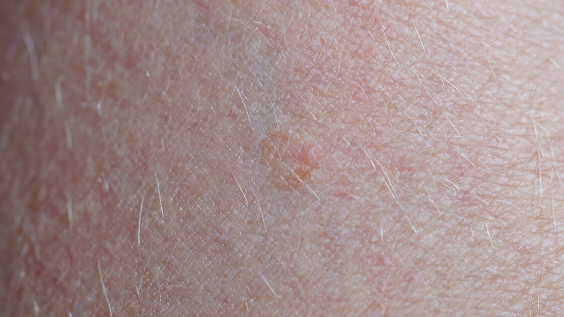 Weißer Hautkrebs Basaliom | DasKrebsportal.de