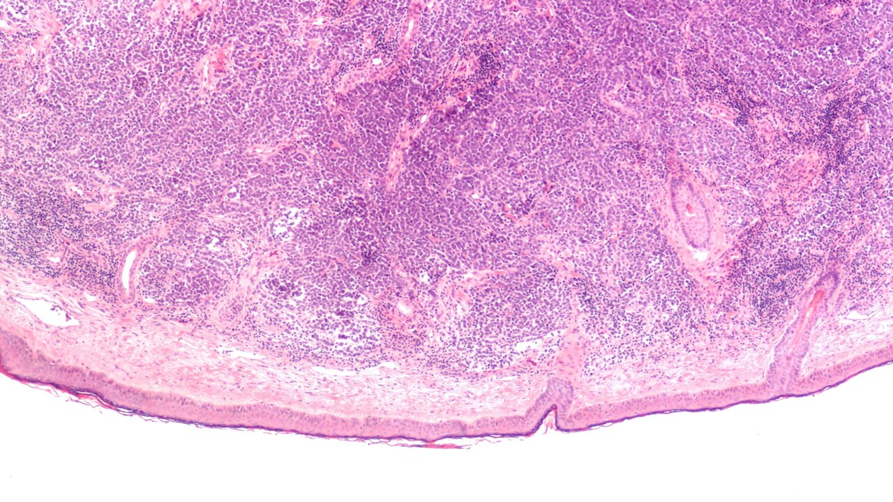 Diagnose Hautkrebs: Merkelzellkarzinom l DasKrebsportal.de
